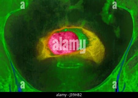 PROSTATIC ADENOMA, X-RAY Stock Photo - Alamy