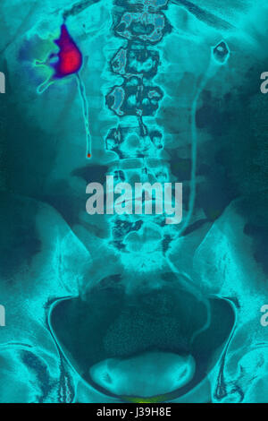 NEPHRITIC COLIC, X-RAY Stock Photo - Alamy