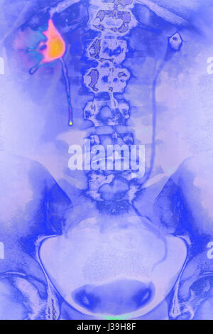 NEPHRITIC COLIC, X-RAY Stock Photo - Alamy