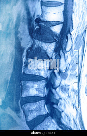 COMPRESSION FRACTURE, MRI Stock Photo - Alamy