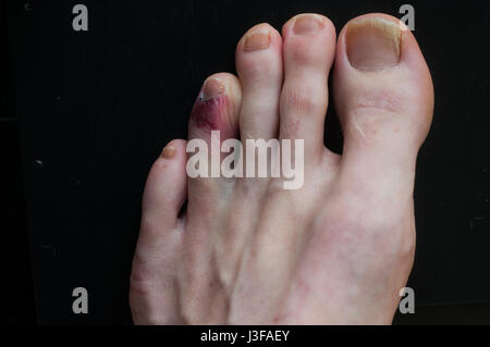Broken toe showing bruising on skin due to injury Stock Photo - Alamy
