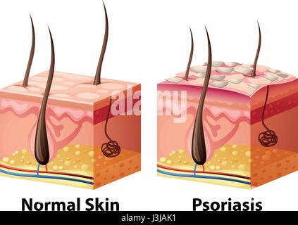 Human skin diagram with normal and psoriasis Stock Vector Image & Art ...