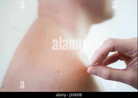 Acupuncturist inserting acupuncture needles into patient's skin Stock ...