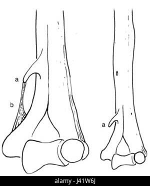 Ligament of Struthers 1854 Stock Photo - Alamy