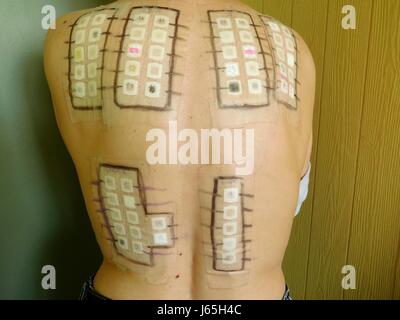 skin prick allergy test on the back of a 13 yo girl Stock Photo - Alamy