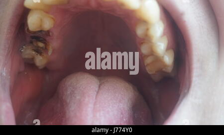 Bad teeth of a guy. Rotten and yellow teeth Stock Photo - Alamy