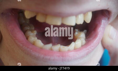 Bad teeth of a guy. Rotten and yellow teeth Stock Photo - Alamy