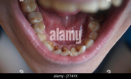 Bad teeth of a guy. Rotten and yellow teeth Stock Photo - Alamy