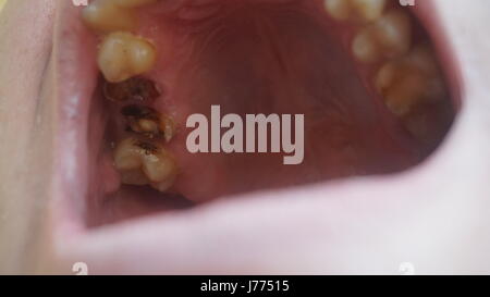 Bad teeth of a guy. Rotten and yellow teeth Stock Photo - Alamy
