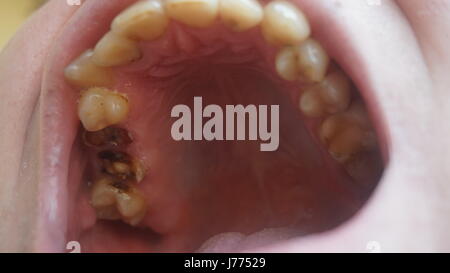 Bad teeth of a guy. Rotten and yellow teeth Stock Photo - Alamy