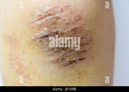 Closed up of red scab injury on woman knee background Stock Photo - Alamy