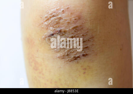 Closed up of red scab injury on woman knee background Stock Photo - Alamy