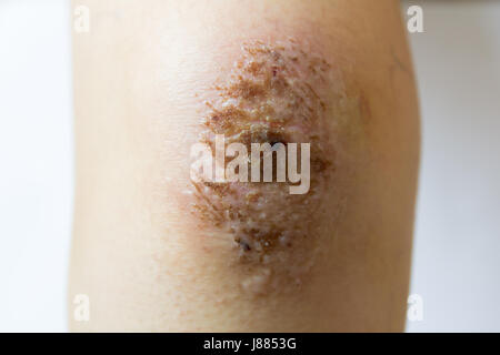 Closed up of red scab injury on woman knee background Stock Photo - Alamy