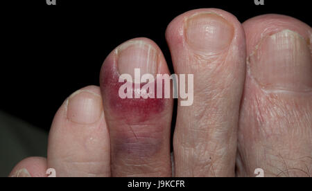 Bruised middle toe Stock Photo - Alamy