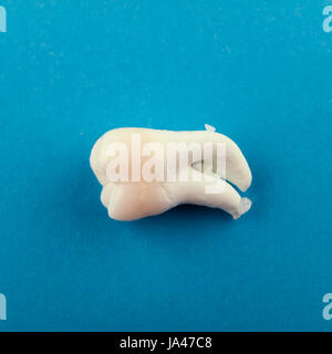 Decayed wisdom tooth Stock Photo - Alamy
