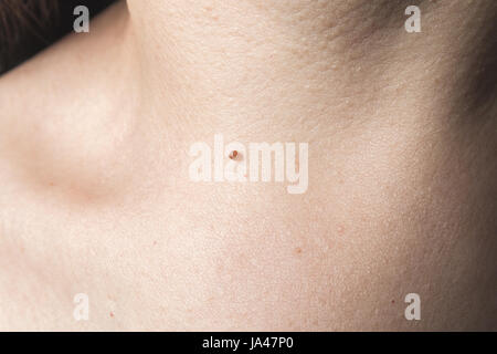 Mole. Close-up of a mole on the neck of a 73-year-old woman. Moles are ...