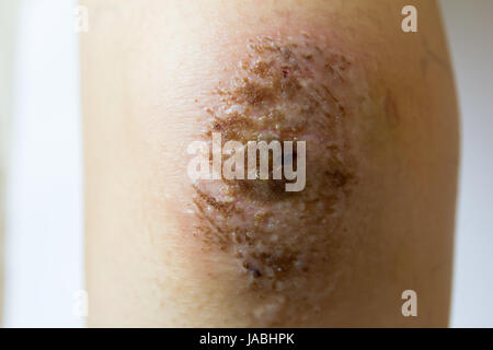 Closed up of red scab injury on woman knee background Stock Photo - Alamy