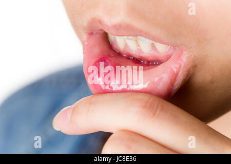 Woman suffer from mouth aphtha Stock Photo - Alamy