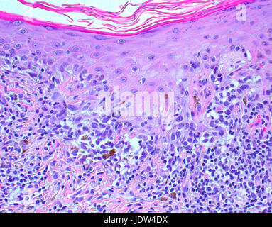Microscope view of malignant melanoma Stock Photo - Alamy