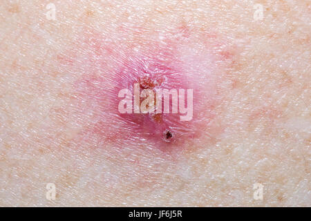 BASAL CELL CARCINOMA Stock Photo - Alamy