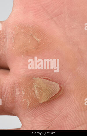 Calluses on hand macro closeup from calisthenics Stock Photo: 135807239 ...