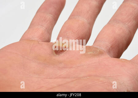 Calluses on hand macro closeup from calisthenics Stock Photo - Alamy