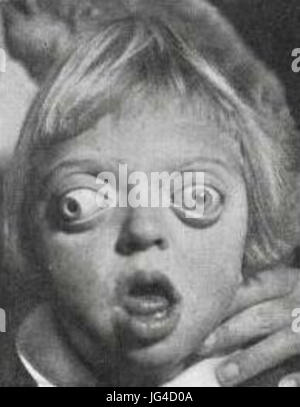 Crouzon Syndrome 4 Stock Photo - Alamy