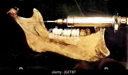 Still life illustration featuring a syringe penetrating into the jaw of ...