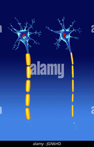 Illustration of a healthy nerve, with axon and myelin sheath, and its ...