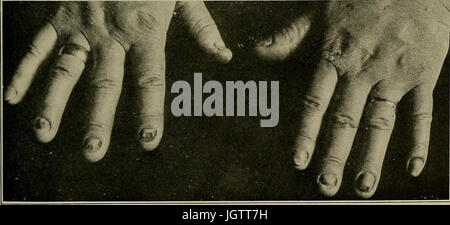 . Syphilis : a treatise on etiology, pathology, diagnosis, prognosis ...