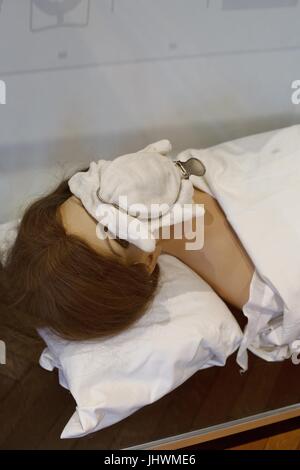 A display depicting the use of chloroform inhalers, at the Surgical ...