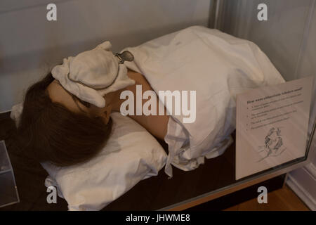 A display depicting the use of chloroform inhalers, at the Surgical ...