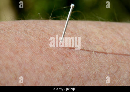 Human arm with acupuncture needle Stock Photo - Alamy