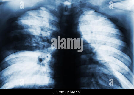 Lobar pneumonia . film chest x-ray show alveolar infiltration at right ...