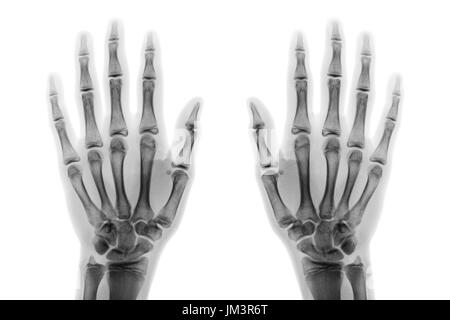 x-ray of forearm isolated on white background Stock Photo - Alamy