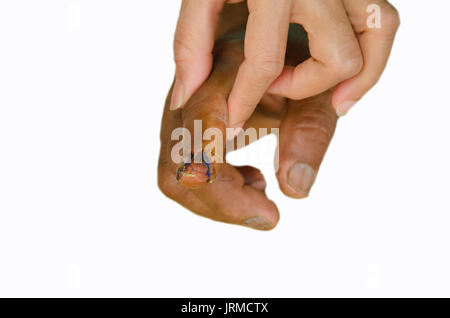 finger injury and dressing wound on white background Stock Photo - Alamy
