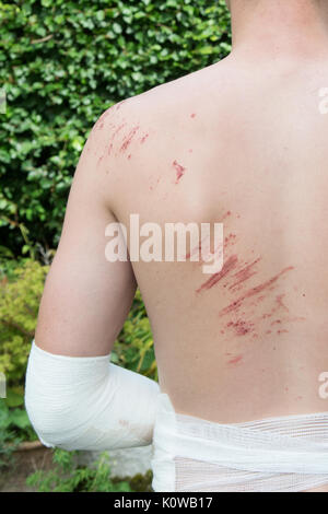 cuts and grazes - downhill mountain biking injury to side of young man ...