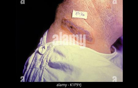 Anthrax skin lesion Stock Photo - Alamy
