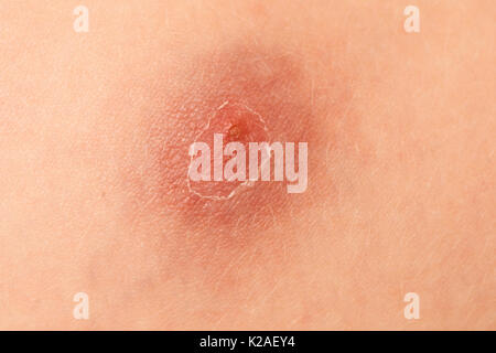 Molluscum contagiosum, virus, water warts, on bottom of a four year old ...