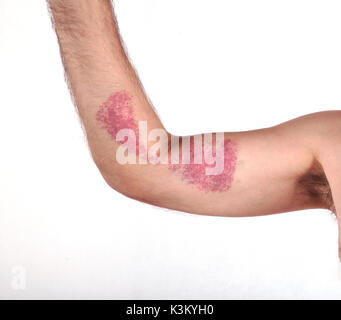 Bruise or hematoma on an arm Stock Photo: 222581780 - Alamy