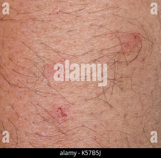 closeup of spot with scab over caucasian skin Stock Photo - Alamy