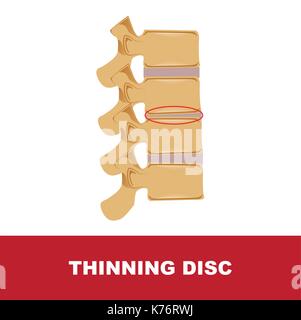 human disc degeneration. degeneration with osteophyte formation. vector ...