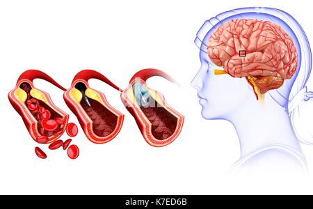 Illustration of brain stent angioplasty to treat and prevent a stroke ...