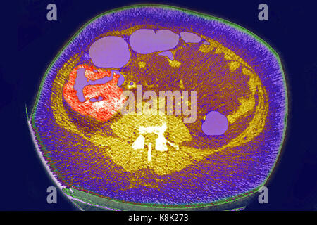 COLON CANCER CT SCAN Stock Photo - Alamy