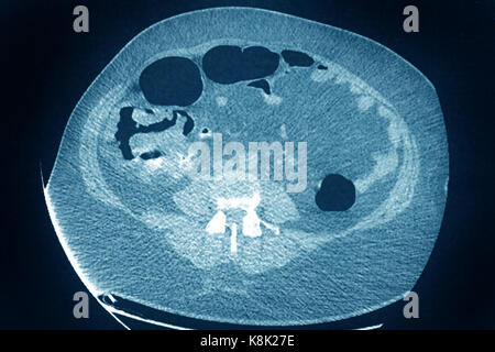 COLON CANCER CT SCAN Stock Photo - Alamy