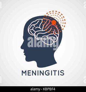 Medical illustration of symptoms of bacterial meningitis Stock Vector ...