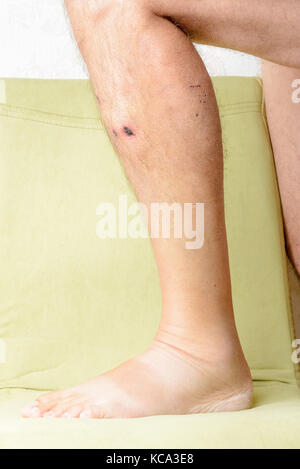 Dog Bite Scar Stock Photo - Alamy