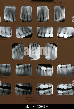 Root canal dental X-ray. X-ray of a tooth filled during root canal ...