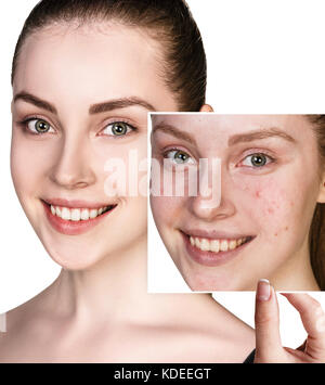 Woman shows photo with bad skin before treatment Stock Photo - Alamy