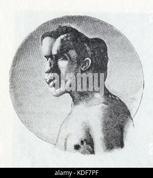 Joseph Merrick, famously known as the 'Elephant Man', photographed in ...